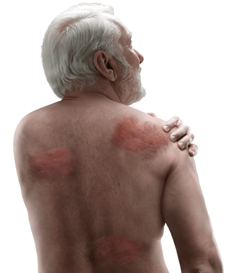 Mycosis Fungoides (MF) | POTELIGEO® (mogamulizumab-kpkc)