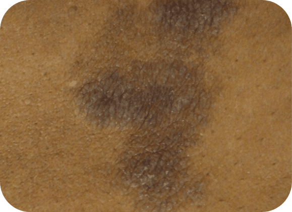 What is Cutaneous T-Cell Lymphoma (CTCL)? | POTELIGEO® (mogamulizumab-kpkc)