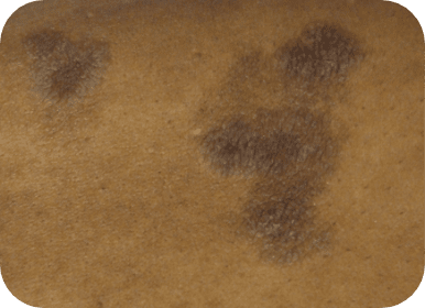 What is Mycosis Fungoides (MF)? | POTELIGEO® (mogamulizumab-kpkc)