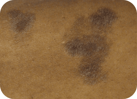 What is Mycosis Fungoides (MF)? | POTELIGEO® (mogamulizumab-kpkc)