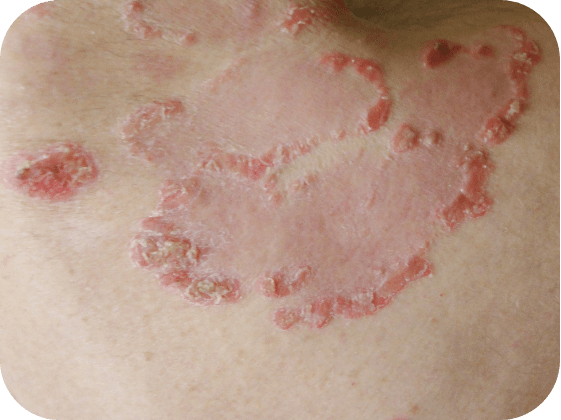 What is Mycosis Fungoides (MF)? | POTELIGEO® (mogamulizumab-kpkc)