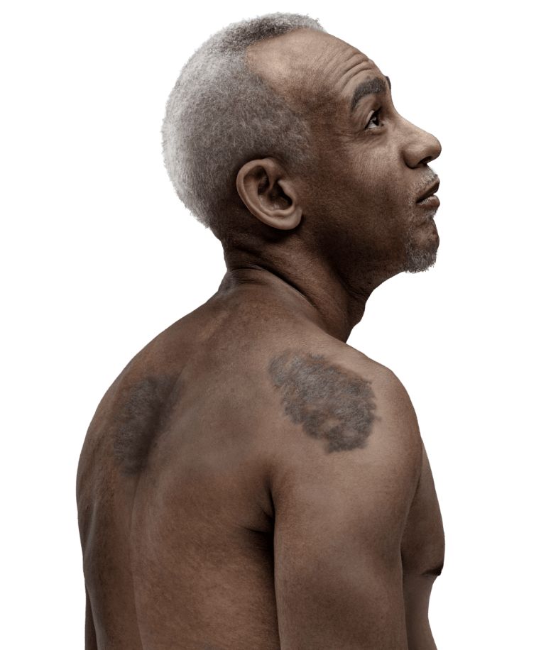 POTELIGEO® (mogamulizumab-kpkc) | Official Patient Website