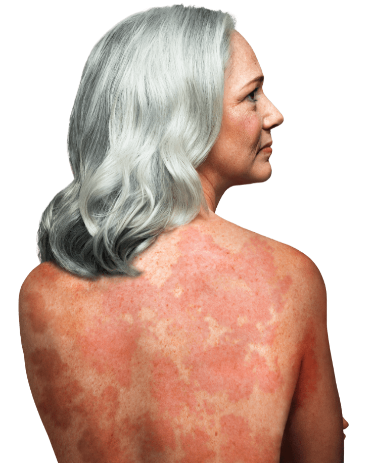 POTELIGEO® (mogamulizumab-kpkc) | Official Patient Website